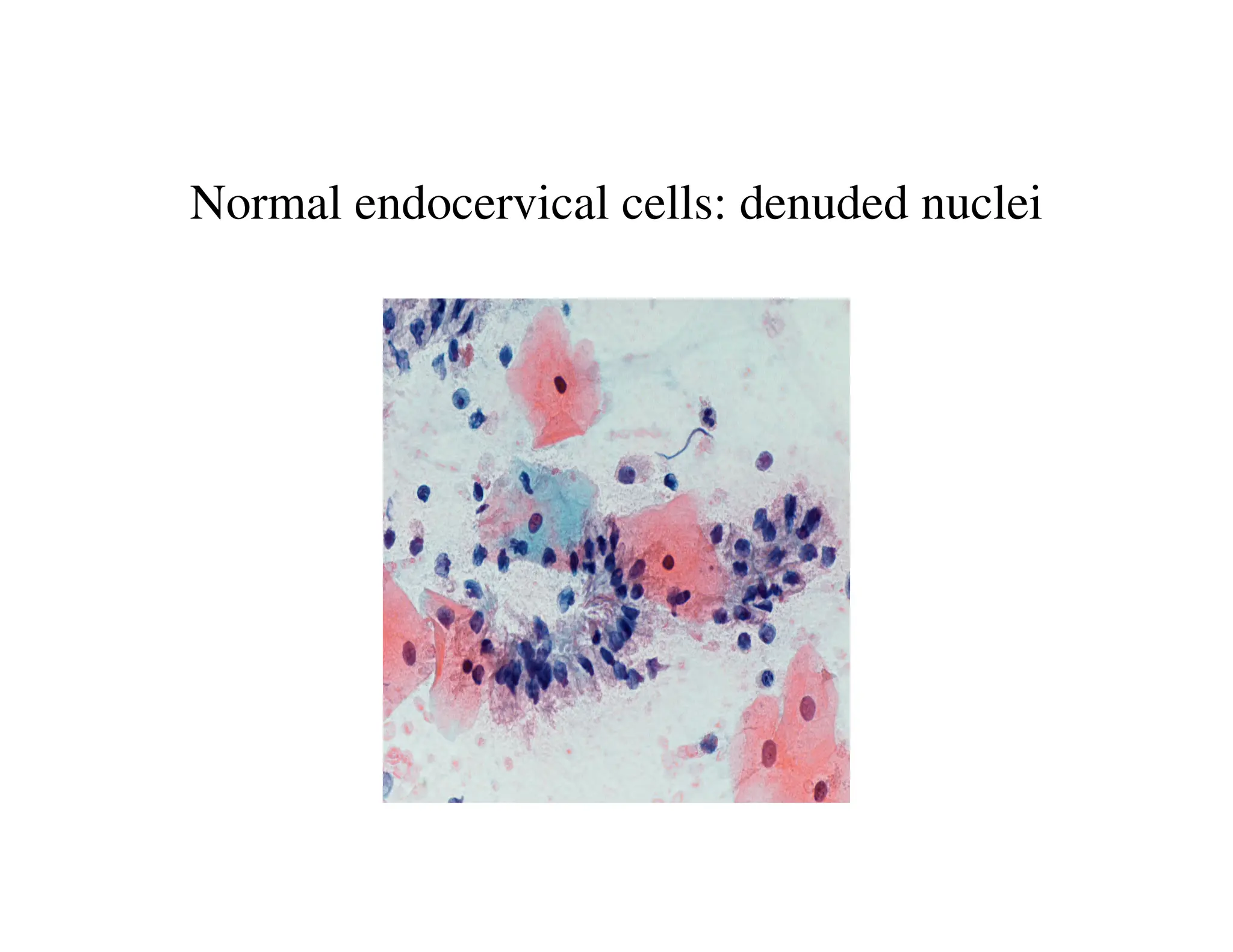 GLANDULAR LESIONS CYTOLOGY IN CERVICAL CYTOLOGY.pdf