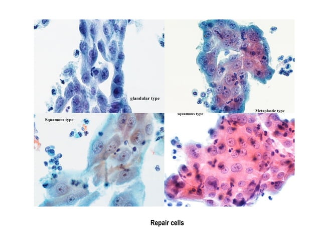 GLANDULAR LESIONS CYTOLOGY IN CERVICAL CYTOLOGY.pdf