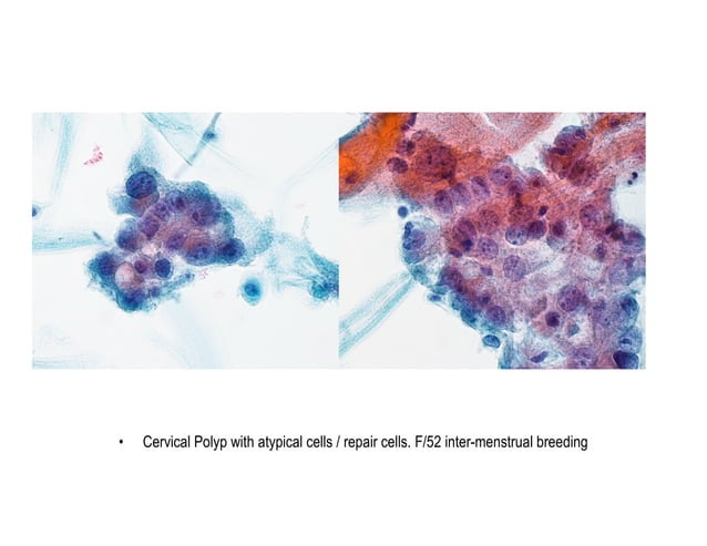 GLANDULAR LESIONS CYTOLOGY IN CERVICAL CYTOLOGY.pdf