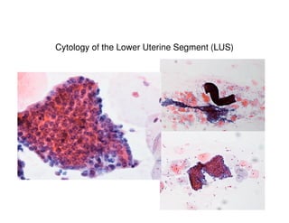 GLANDULAR LESIONS CYTOLOGY IN CERVICAL CYTOLOGY.pdf