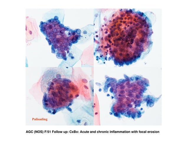 GLANDULAR LESIONS CYTOLOGY IN CERVICAL CYTOLOGY.pdf