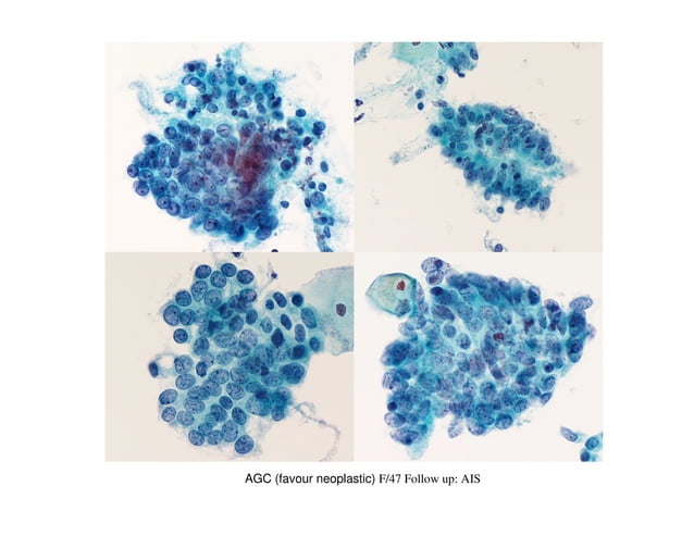 GLANDULAR LESIONS CYTOLOGY IN CERVICAL CYTOLOGY.pdf