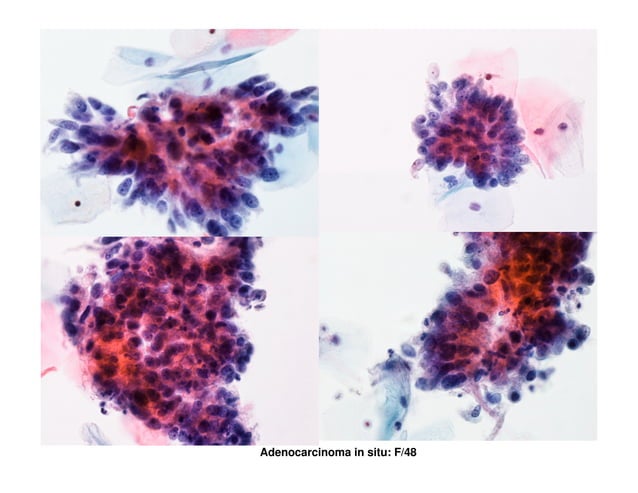 GLANDULAR LESIONS CYTOLOGY IN CERVICAL CYTOLOGY.pdf