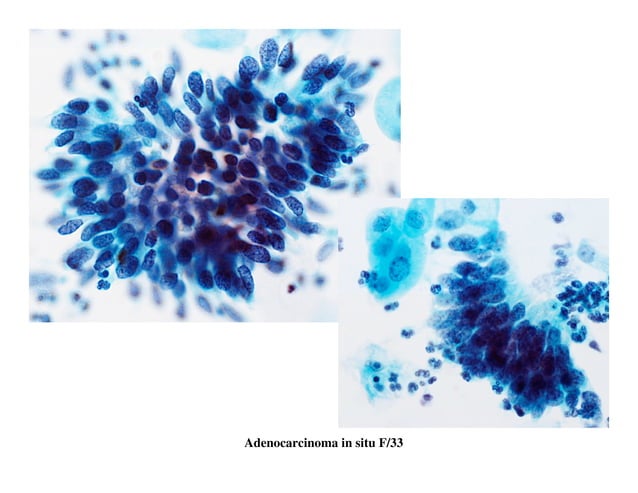 GLANDULAR LESIONS CYTOLOGY IN CERVICAL CYTOLOGY.pdf