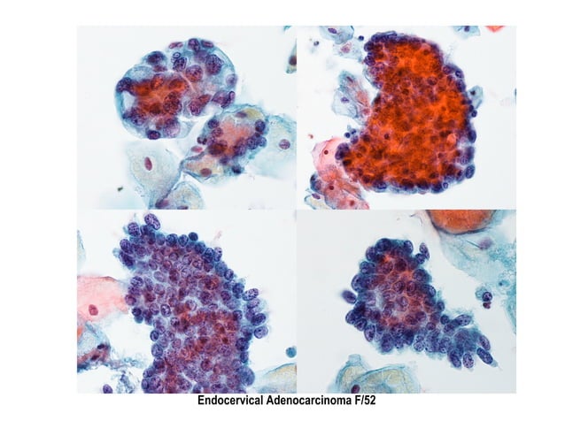 GLANDULAR LESIONS CYTOLOGY IN CERVICAL CYTOLOGY.pdf