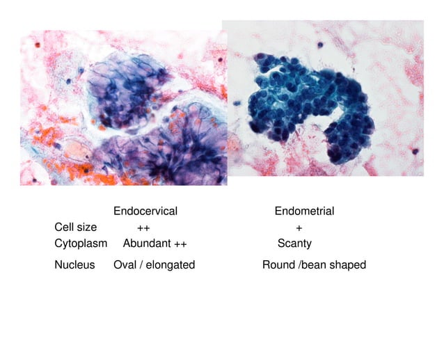 GLANDULAR LESIONS CYTOLOGY IN CERVICAL CYTOLOGY.pdf