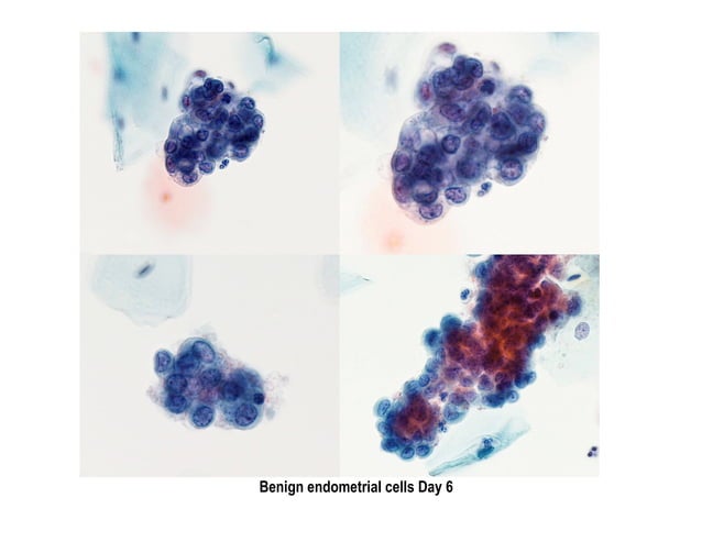 GLANDULAR LESIONS CYTOLOGY IN CERVICAL CYTOLOGY.pdf