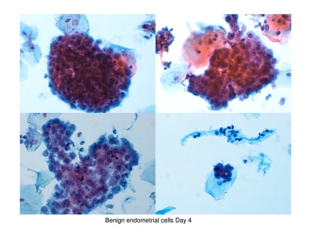 GLANDULAR LESIONS CYTOLOGY IN CERVICAL CYTOLOGY.pdf