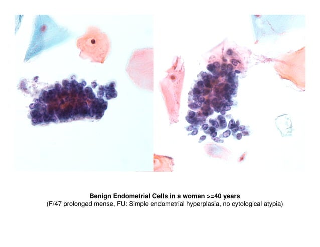 GLANDULAR LESIONS CYTOLOGY IN CERVICAL CYTOLOGY.pdf