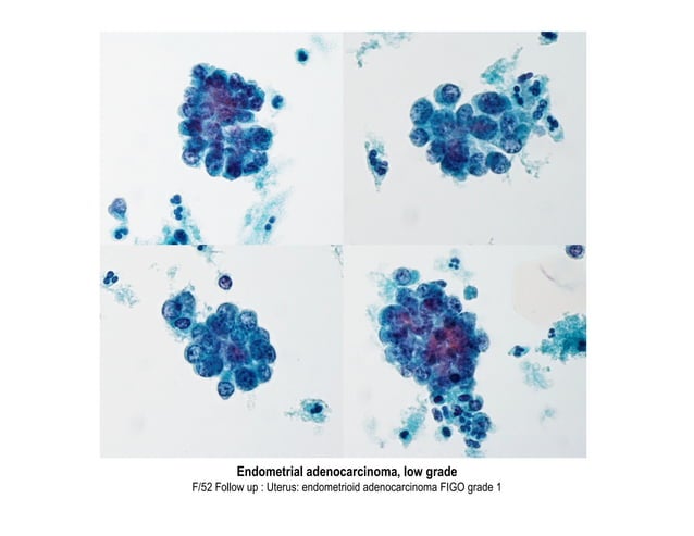 GLANDULAR LESIONS CYTOLOGY IN CERVICAL CYTOLOGY.pdf