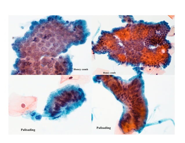 GLANDULAR LESIONS CYTOLOGY IN CERVICAL CYTOLOGY.pdf