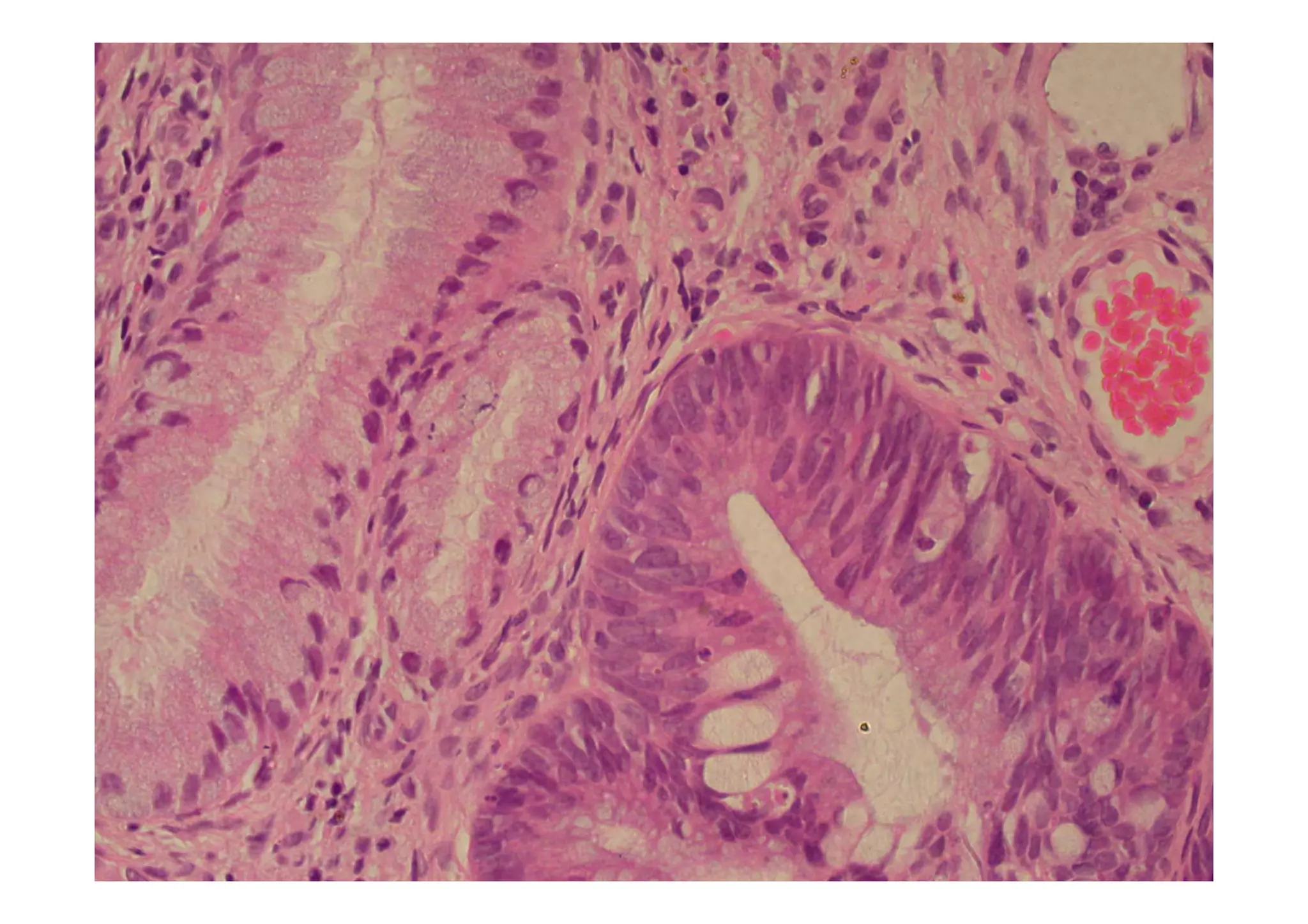 GLANDULAR PATHOLOGY UTERINE CERVIX.pdf