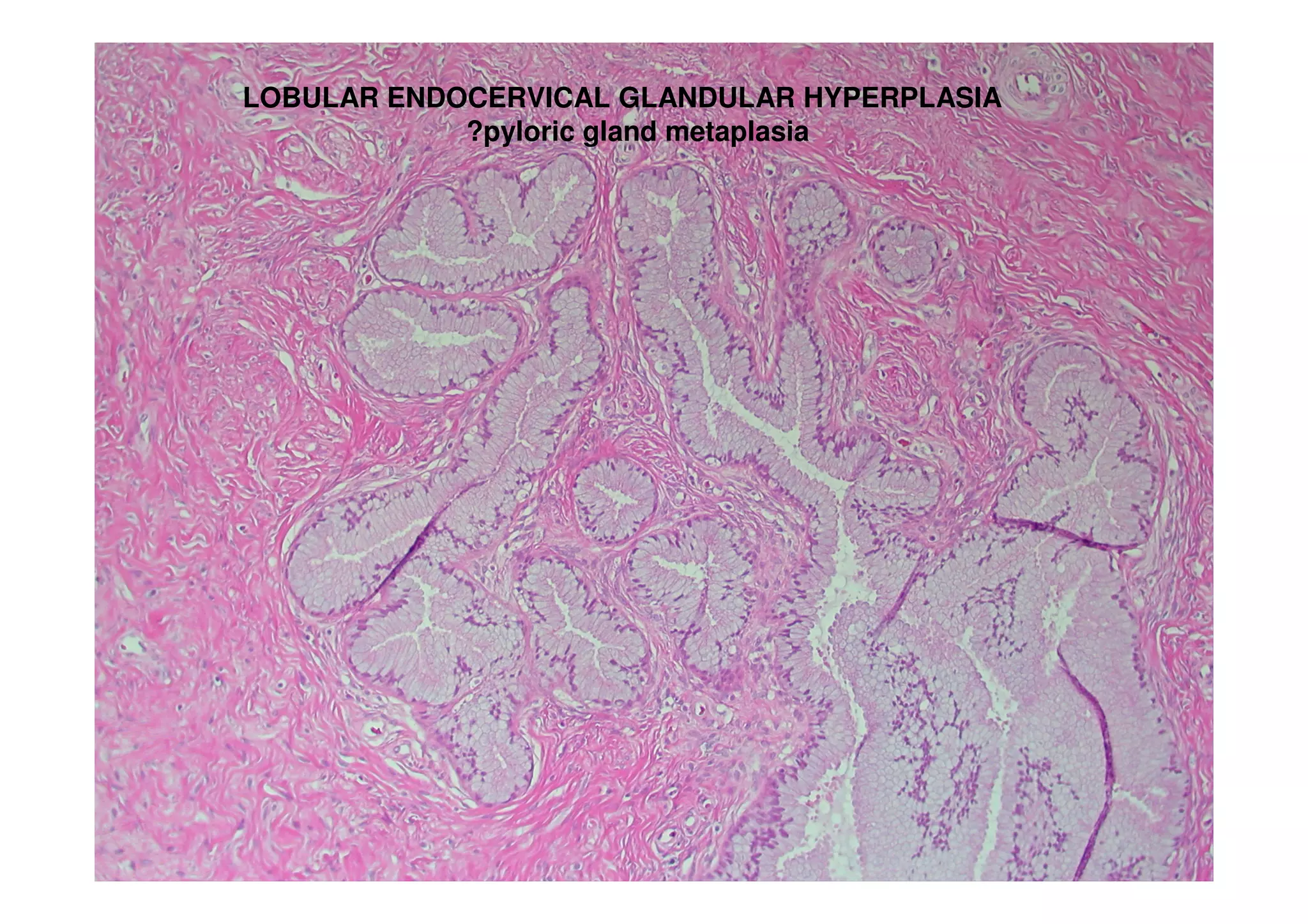 GLANDULAR PATHOLOGY UTERINE CERVIX.pdf