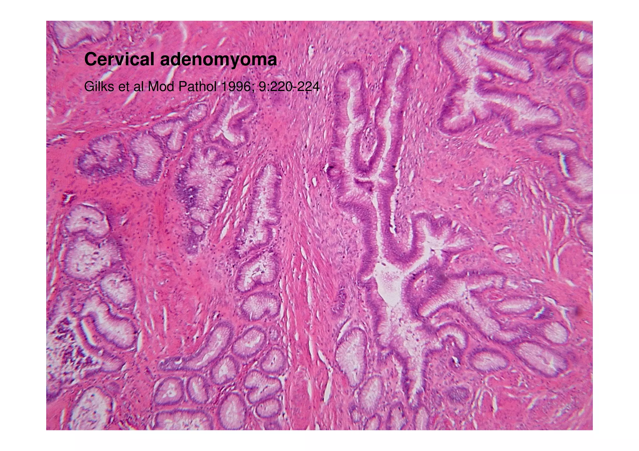 GLANDULAR PATHOLOGY UTERINE CERVIX.pdf