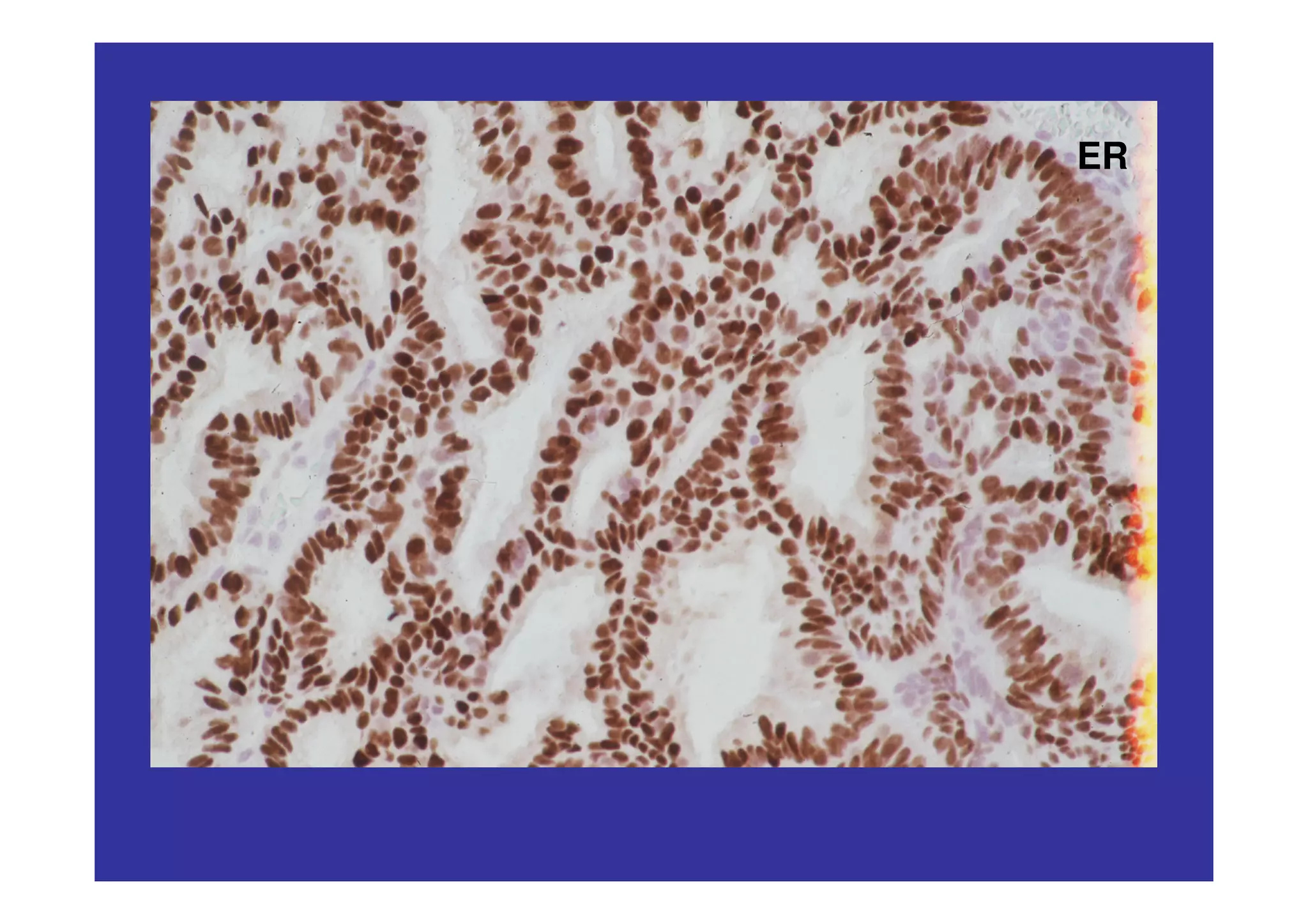 GLANDULAR PATHOLOGY UTERINE CERVIX.pdf