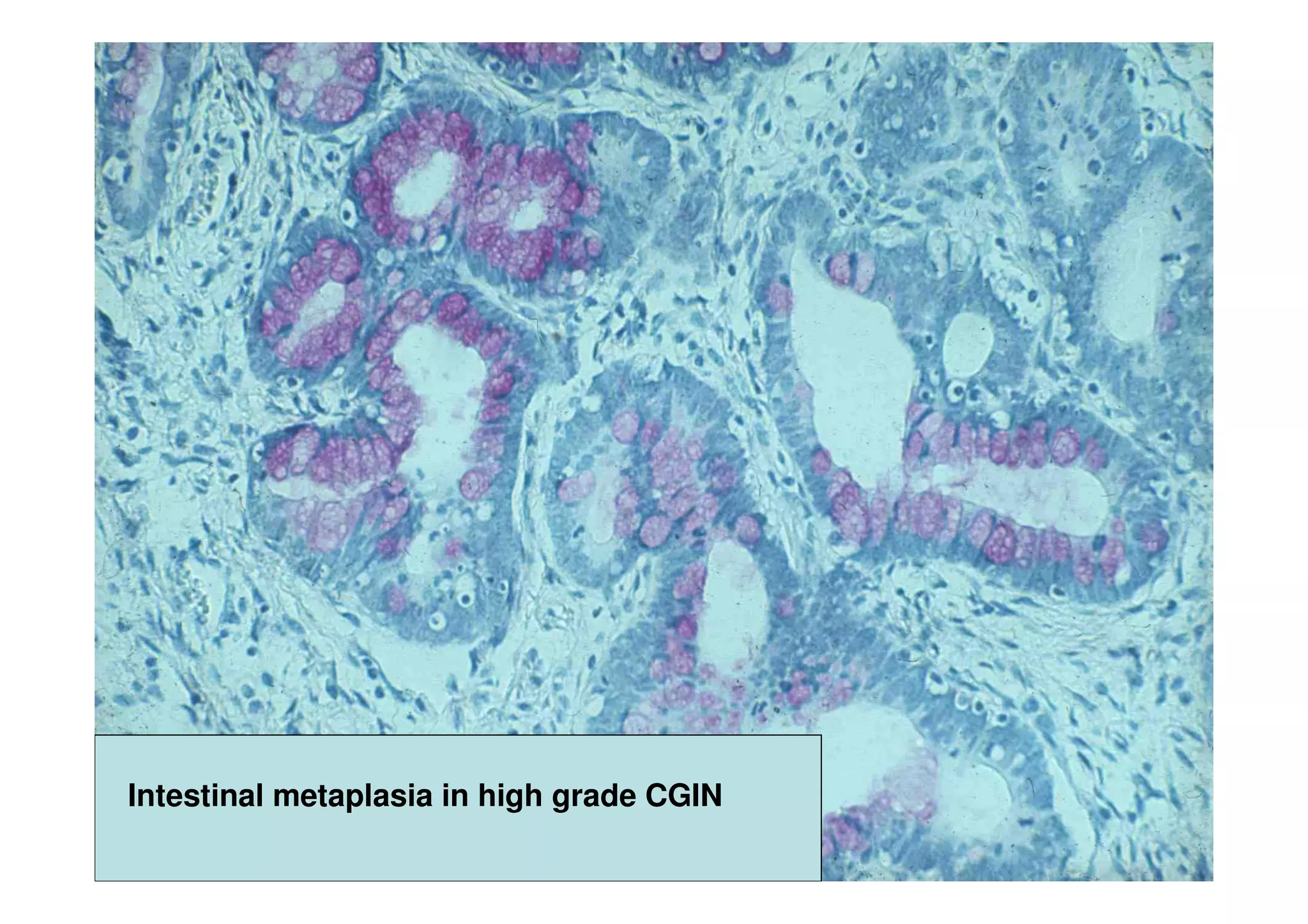 GLANDULAR PATHOLOGY UTERINE CERVIX.pdf