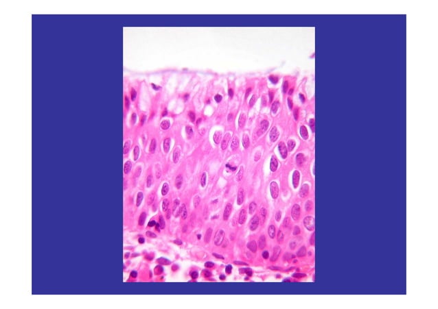 GLANDULAR PATHOLOGY UTERINE CERVIX.pdf | Free Download