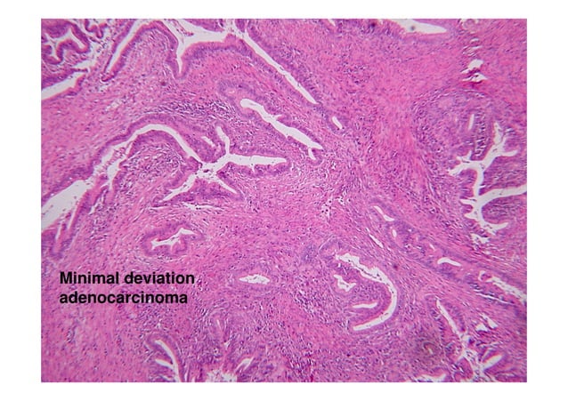 GLANDULAR PATHOLOGY UTERINE CERVIX.pdf