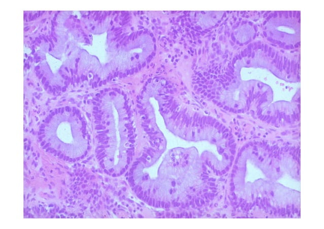 GLANDULAR PATHOLOGY UTERINE CERVIX.pdf