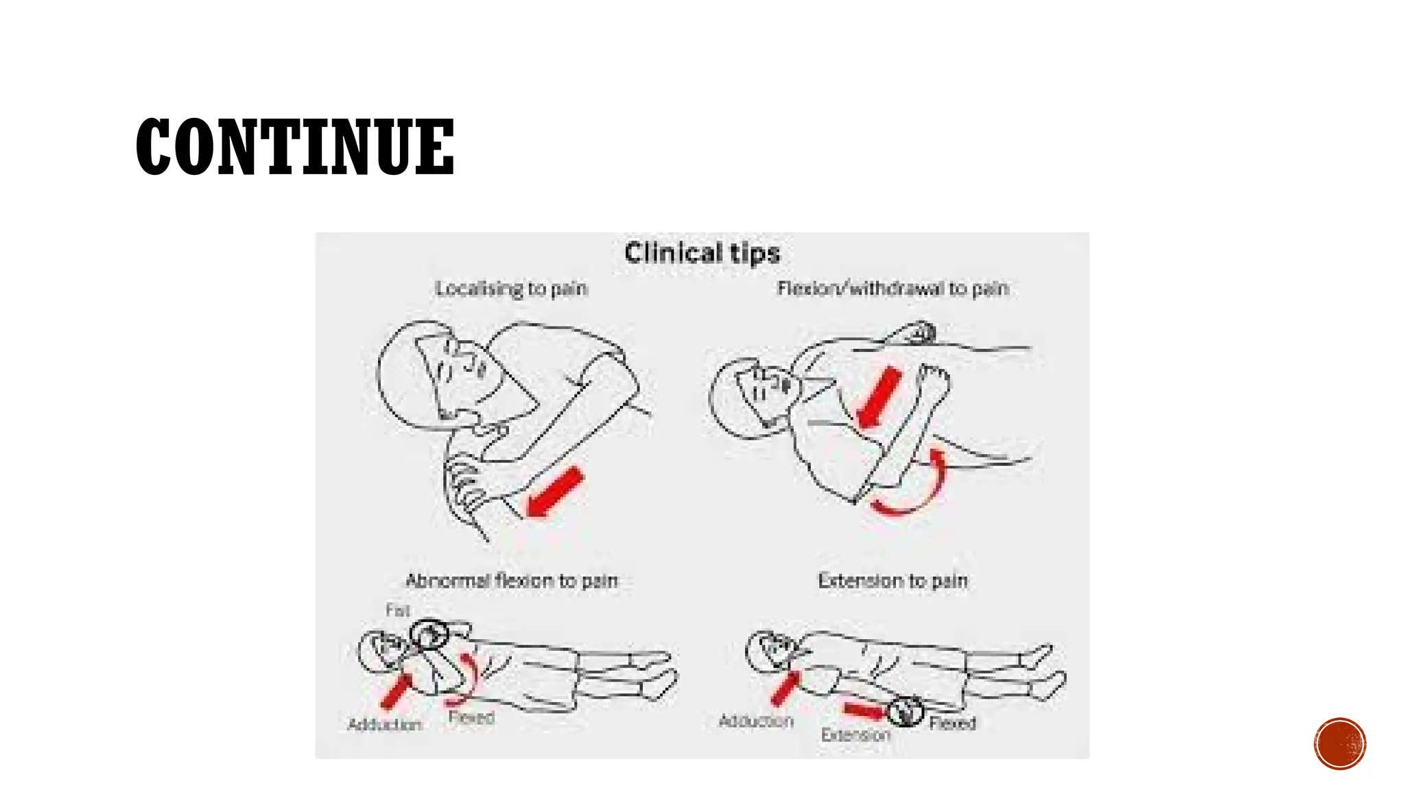Presentation on glasscoma scale in nursing | PPTX