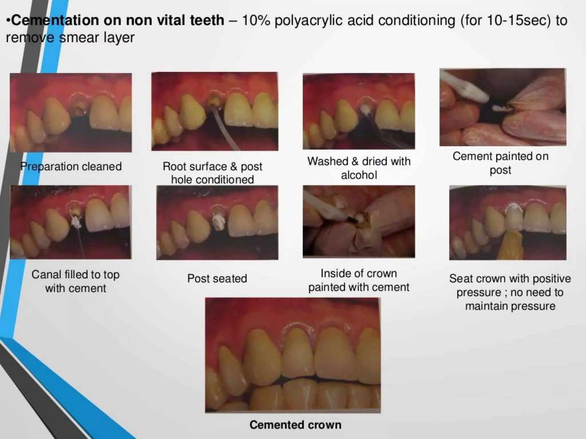 Glass ionomer cement | PPTX