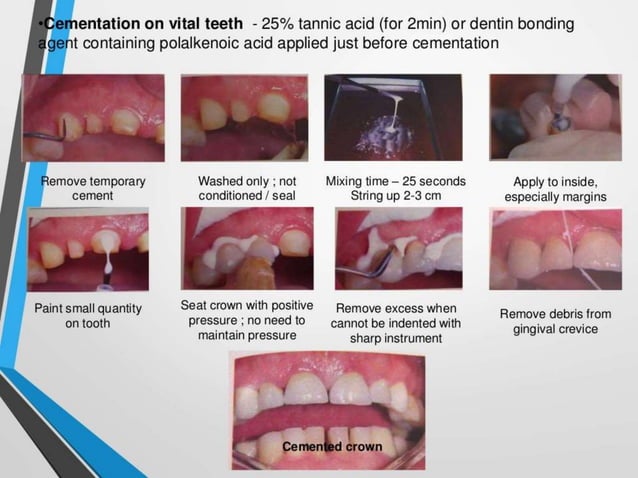 Glass ionomer cement | PPTX | Dental Health | Diseases and Conditions