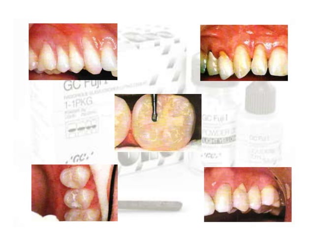 Glass ionomer cement | PPTX | Dental Health | Diseases and Conditions