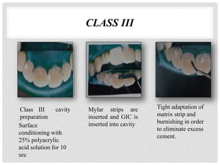 Glass ionomer cement | PPTX