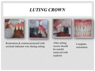 Glass ionomer cement | PPTX