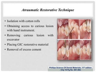 Glass ionomer cement | PPTX