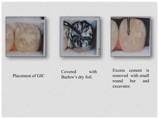 Glass ionomer cement | PPT