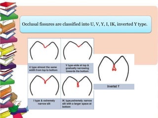 Glass ionomer cements as fissure sealing materials yes or no | PPT