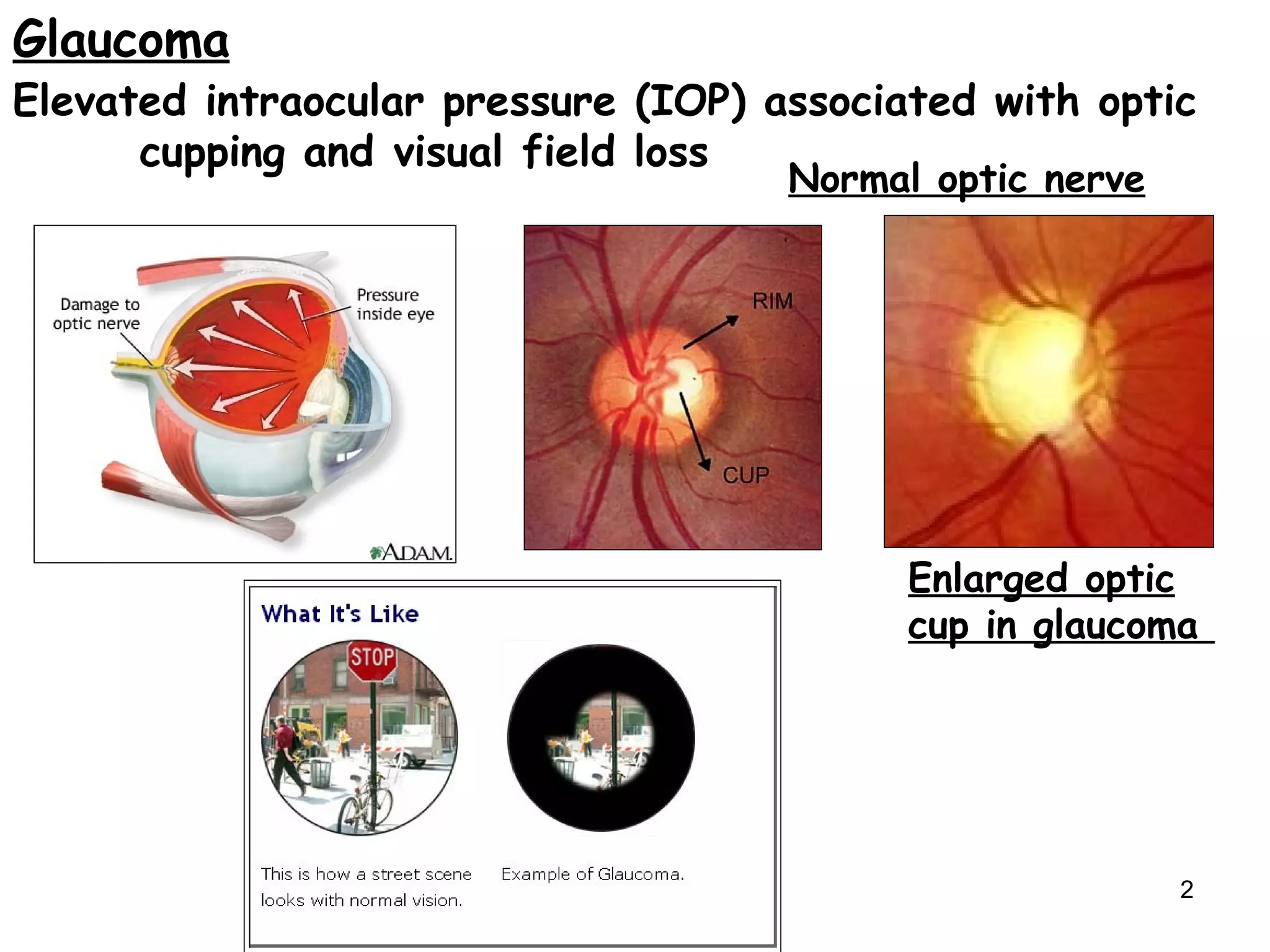 Glaucoma | PPT