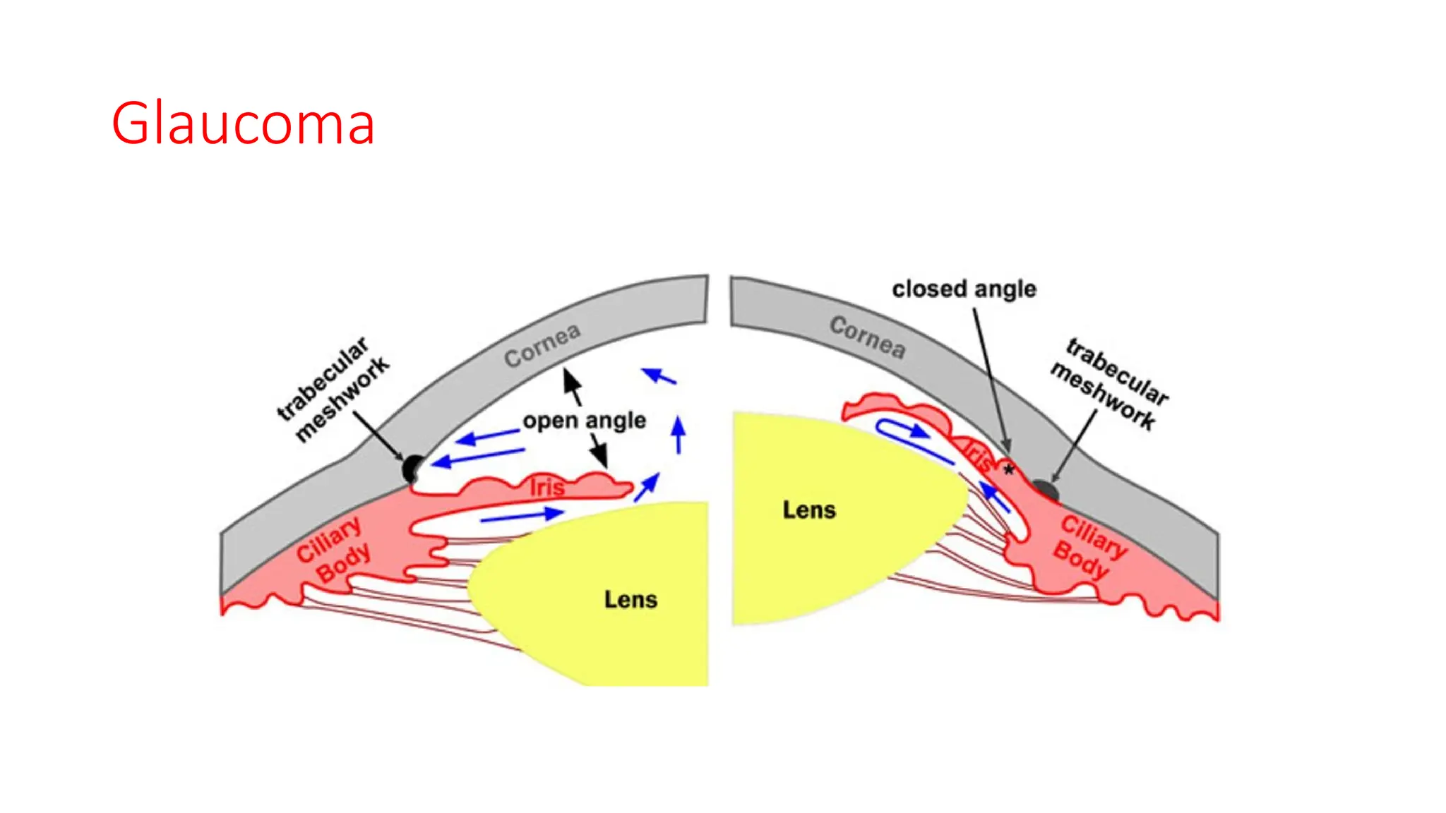 glaucoma diploma class presentation-1.pptx