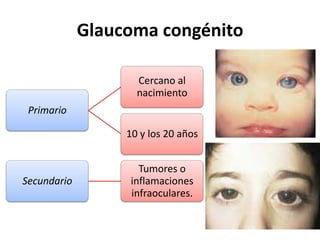 Glaucoma | PPTX