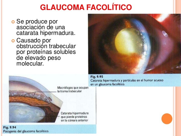 Glaucoma