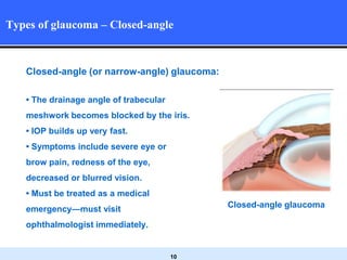 Glaucoma | PPSX
