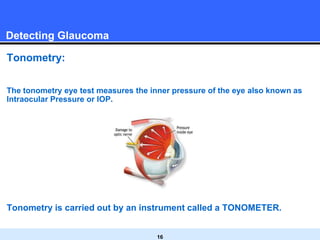 Glaucoma | PPSX