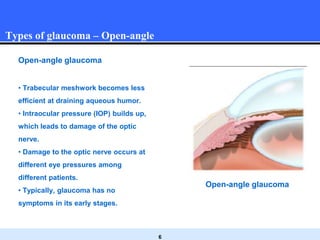 Glaucoma | PPSX