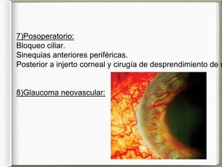 Glaucoma de angulo cerrado y abierto | PPTX