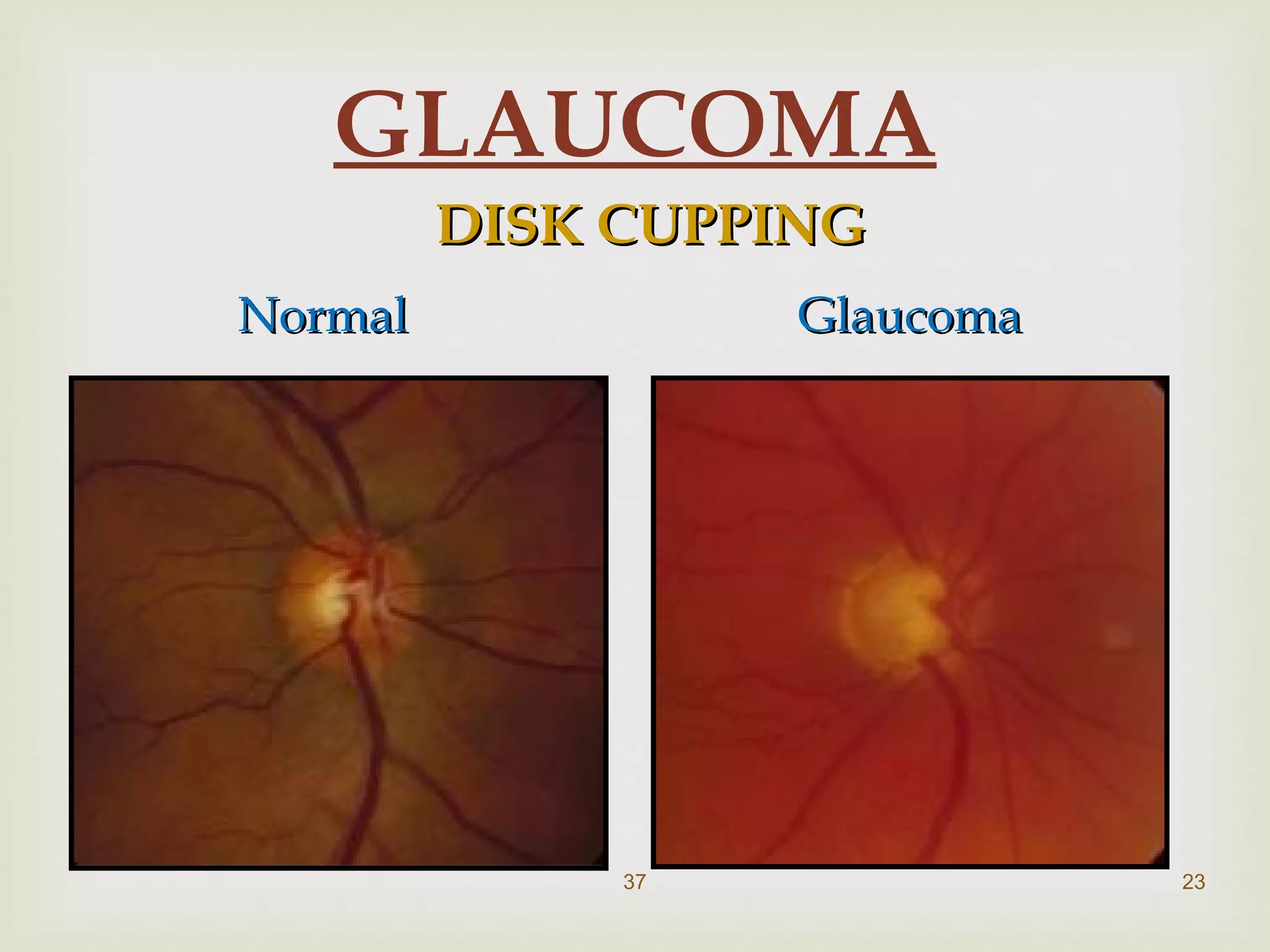 Glaucoma | PPT