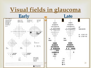 Glaucoma | PPT