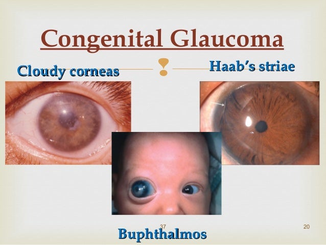 Glaucoma