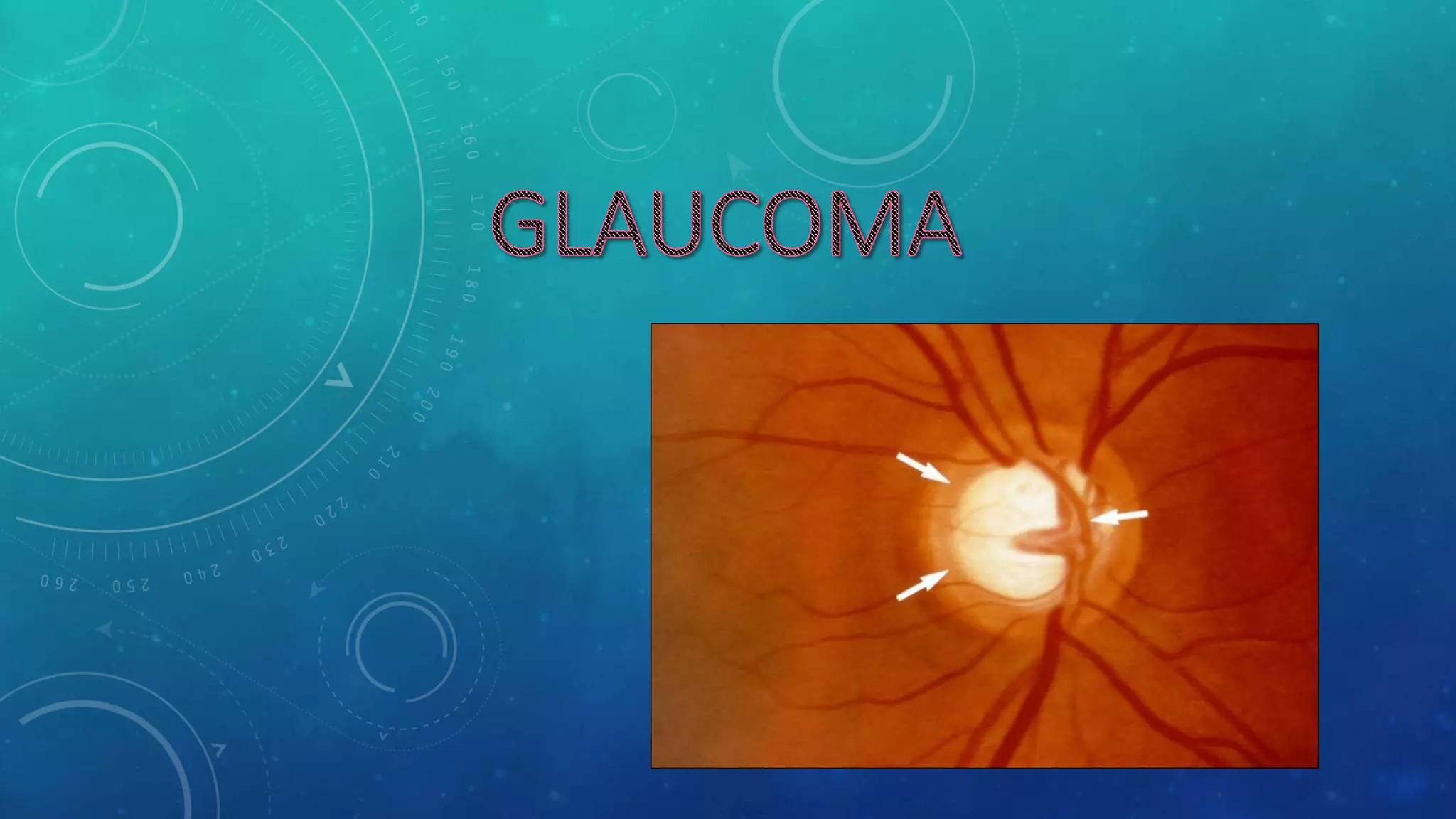 Glaucoma | PPTX