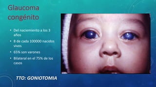 Glaucoma | PPTX