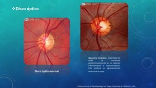 Glaucoma | PPTX