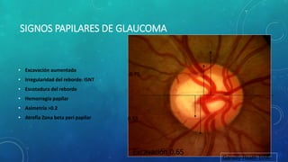 Glaucoma | PPTX