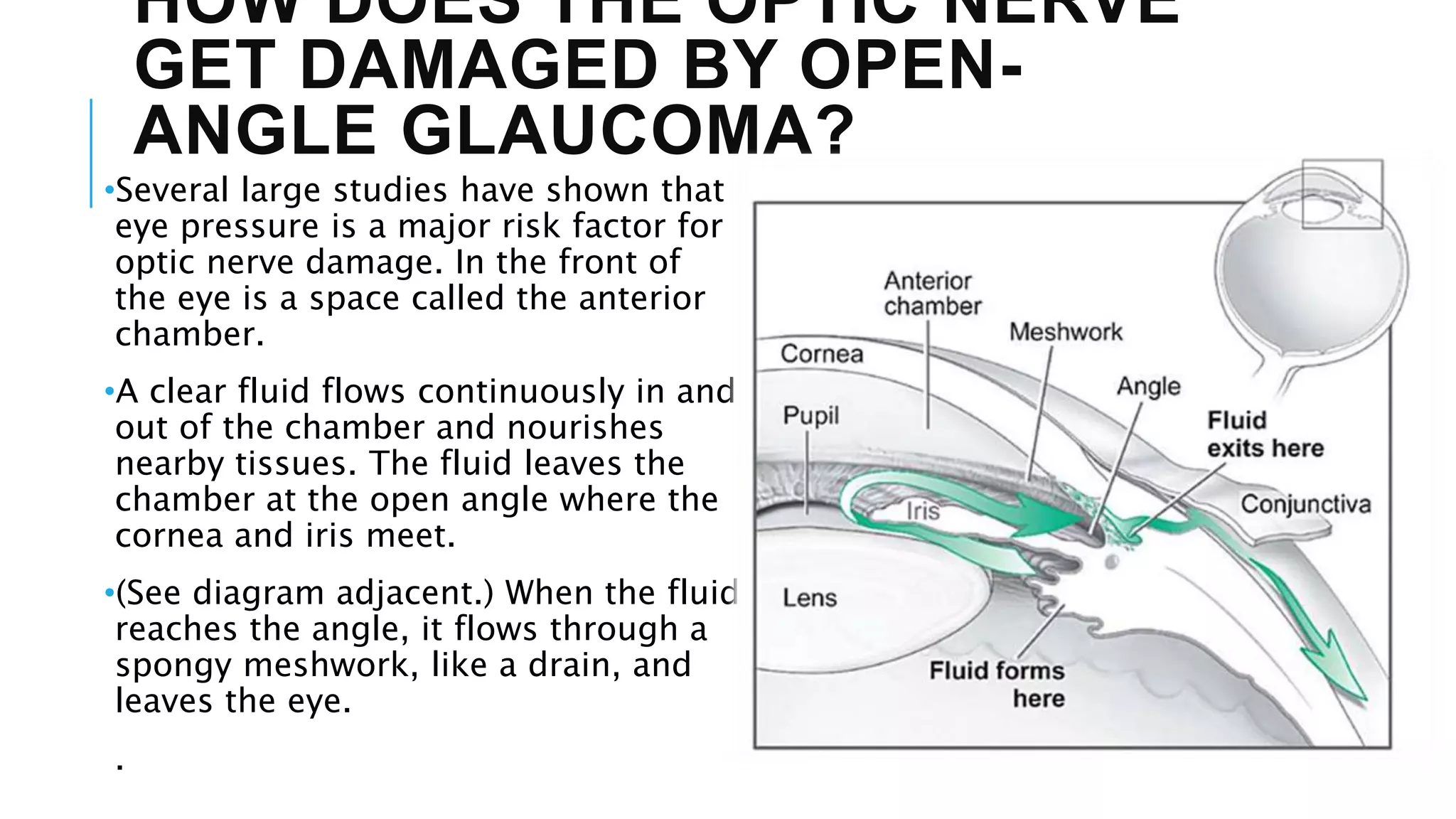 Glaucoma | PPTX