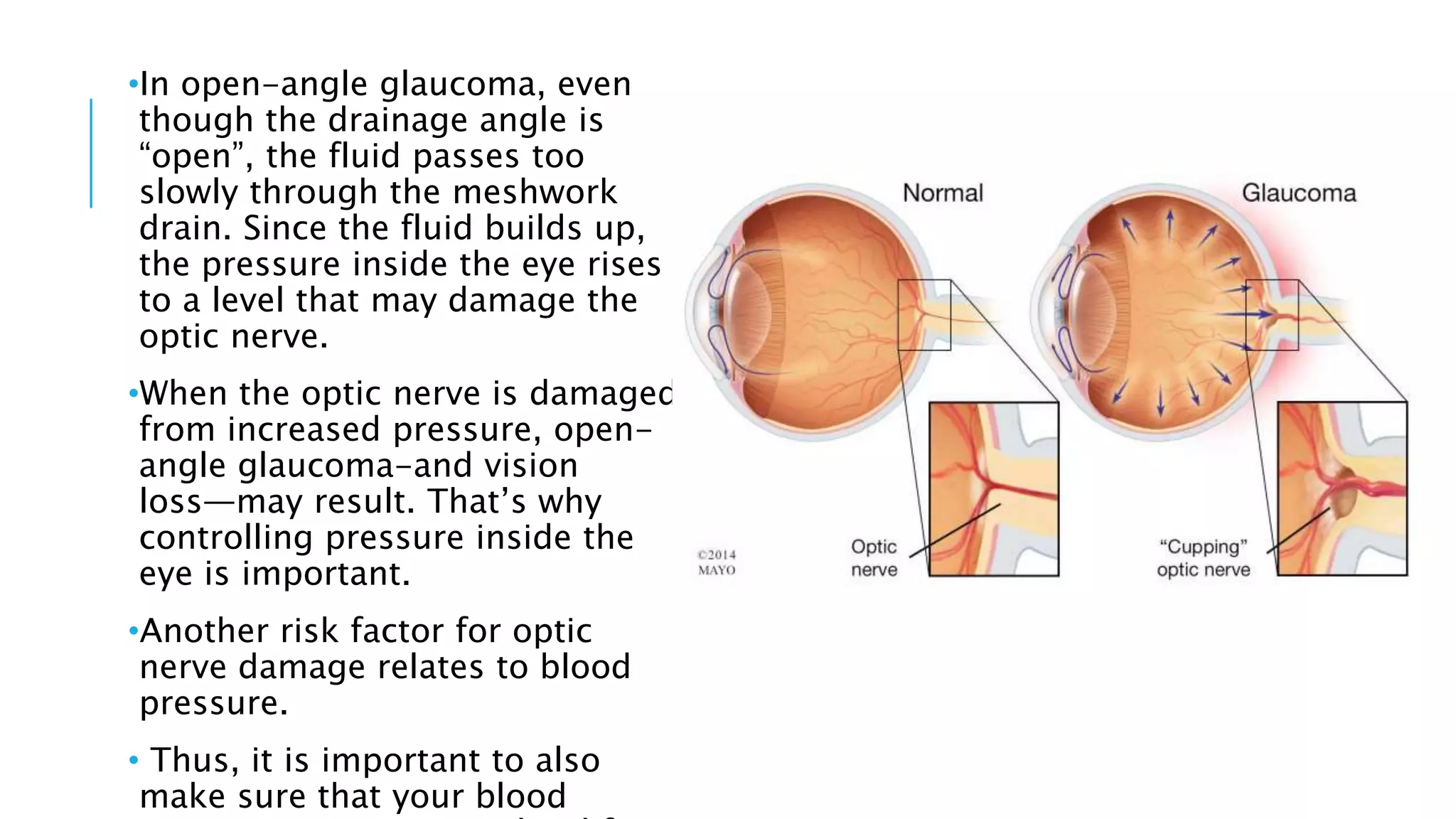 Glaucoma | PPTX