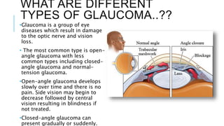 Glaucoma | PPT